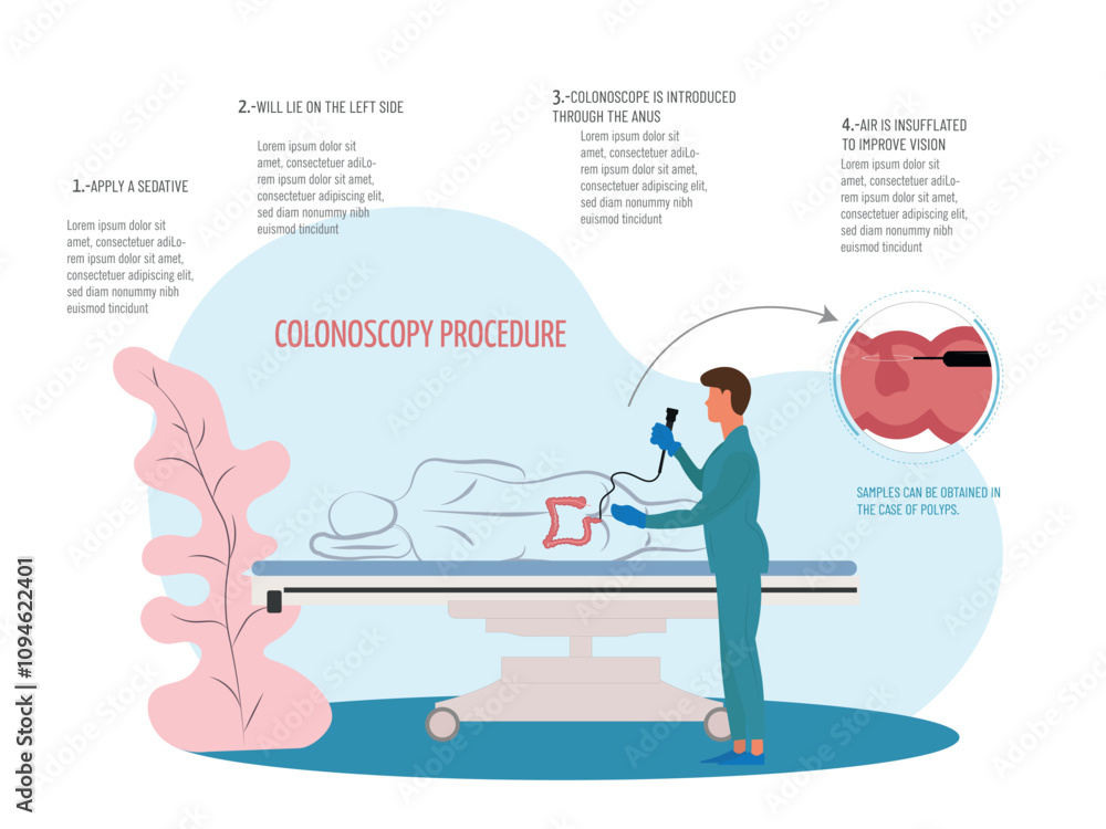 Colonoscopy procedure.Medical illustration showing the steps of a ...