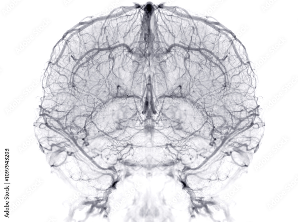 A detailed cerebral angiogram showcasing intricate blood vessels in the ...