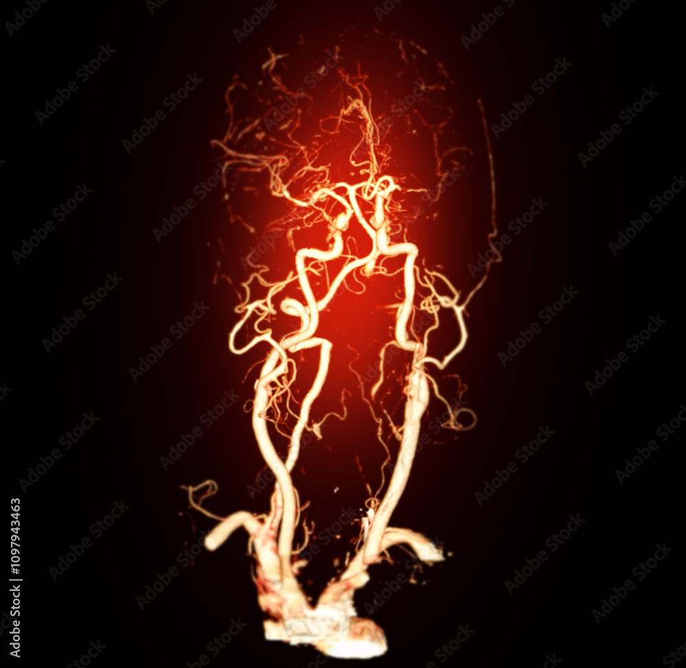 The contrast-enhanced CT Angiography (CTA) of the brain and neck ...