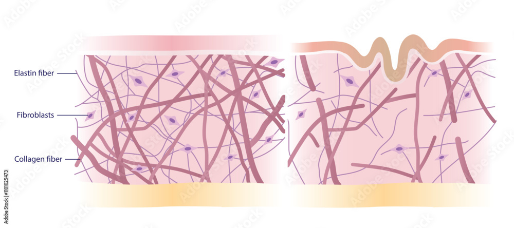 Poster Cross section of skin layer with intact and damaged collagen ...