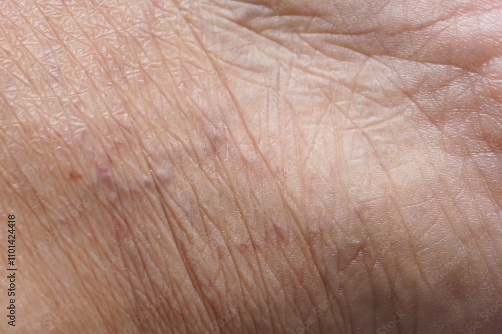 Closeup of wrinkles in skin in deep layers and varicose veins Skin ...