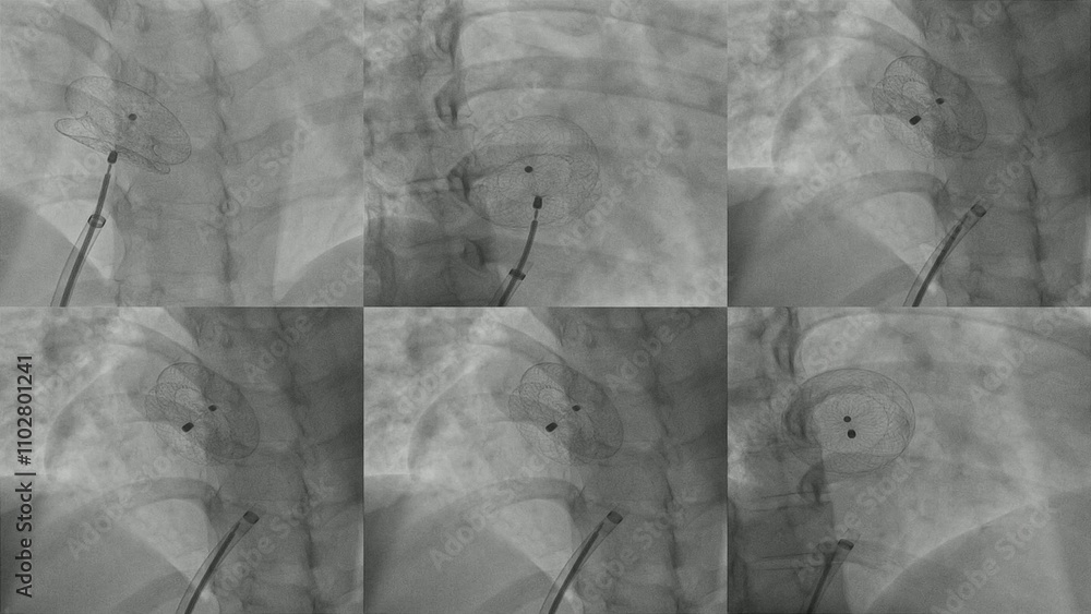 Foto de X-Ray Image Showing Atrial Septal Occluder Device Placement in ...