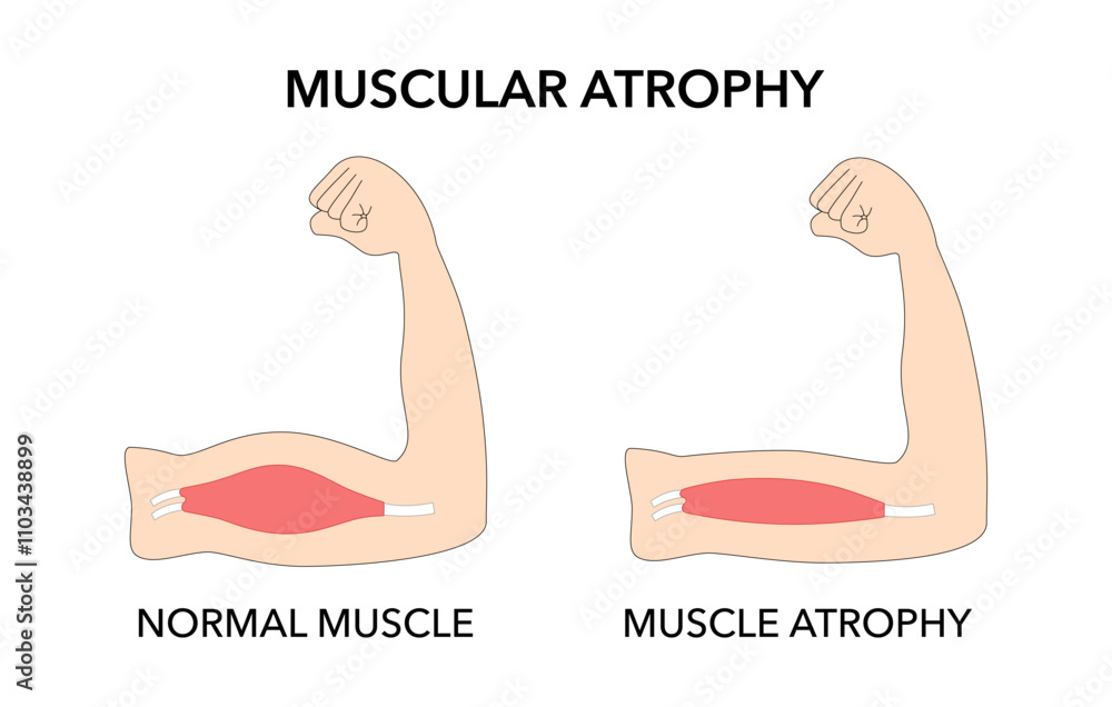Muscular atrophy compared to healthy outline diagram. Weakness abnormal ...