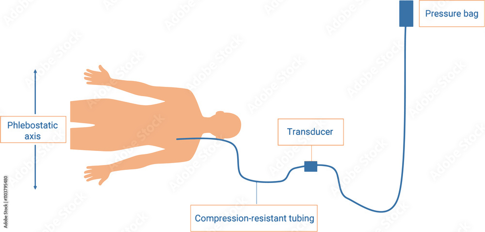 Measuring central venous pressure in humans. CVP is measured through a ...