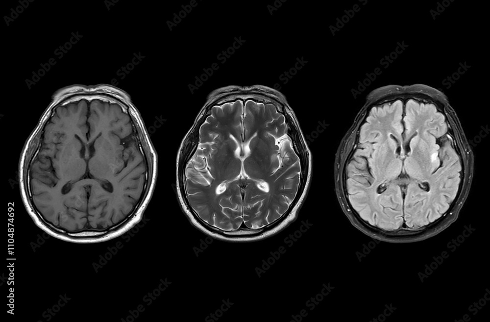 Póster MRI brain scan axial T1W ,T2W and Flair for detect Brain ...