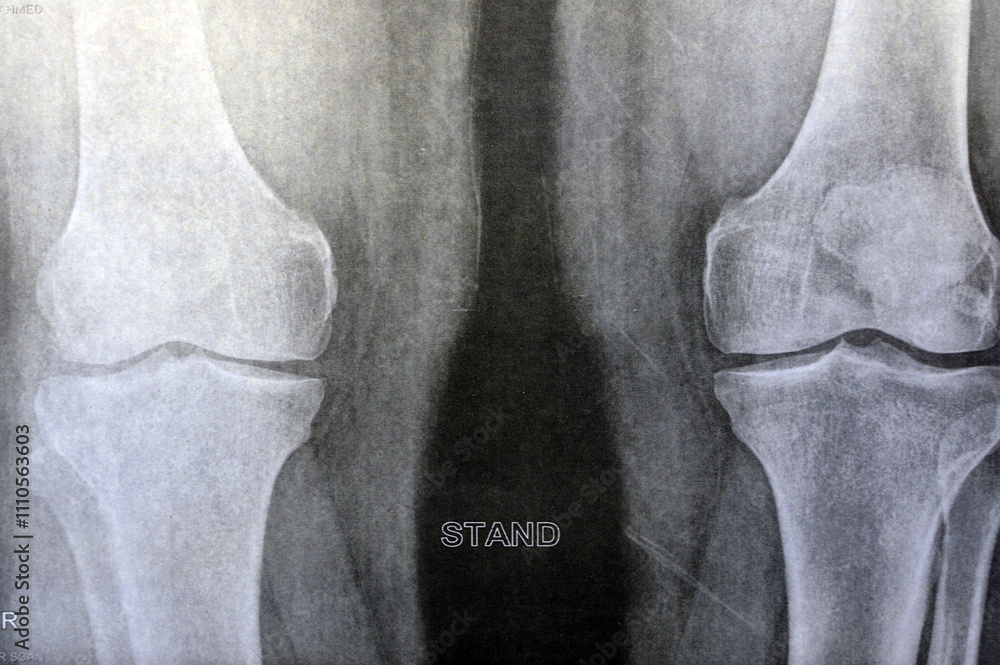 Plain x-ray of the knee showing apparent joint osteoarthritis according ...