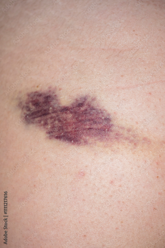 Bruise on body. Hematoma. Closeup Bruise on body. Close up on a bruise ...