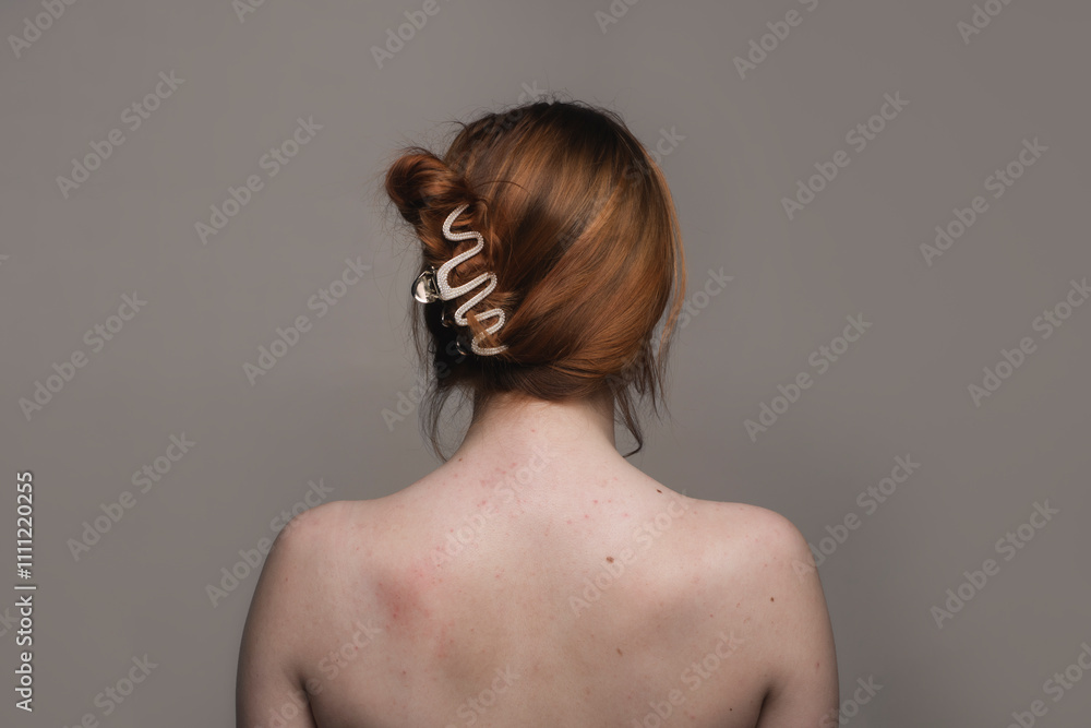 Skin texture. Acne pimple on back. Treatment for skin. Problem skincare ...