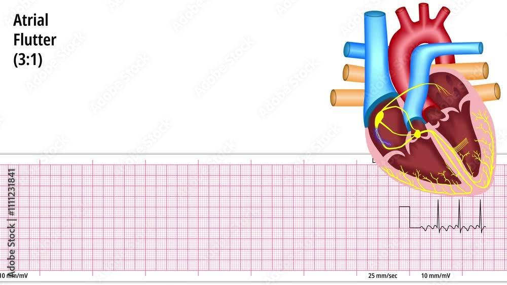 Atrial Flutter 3:1- ECG and Heart Conduction - Electrocardiogram Medical Animation vídeo do ...