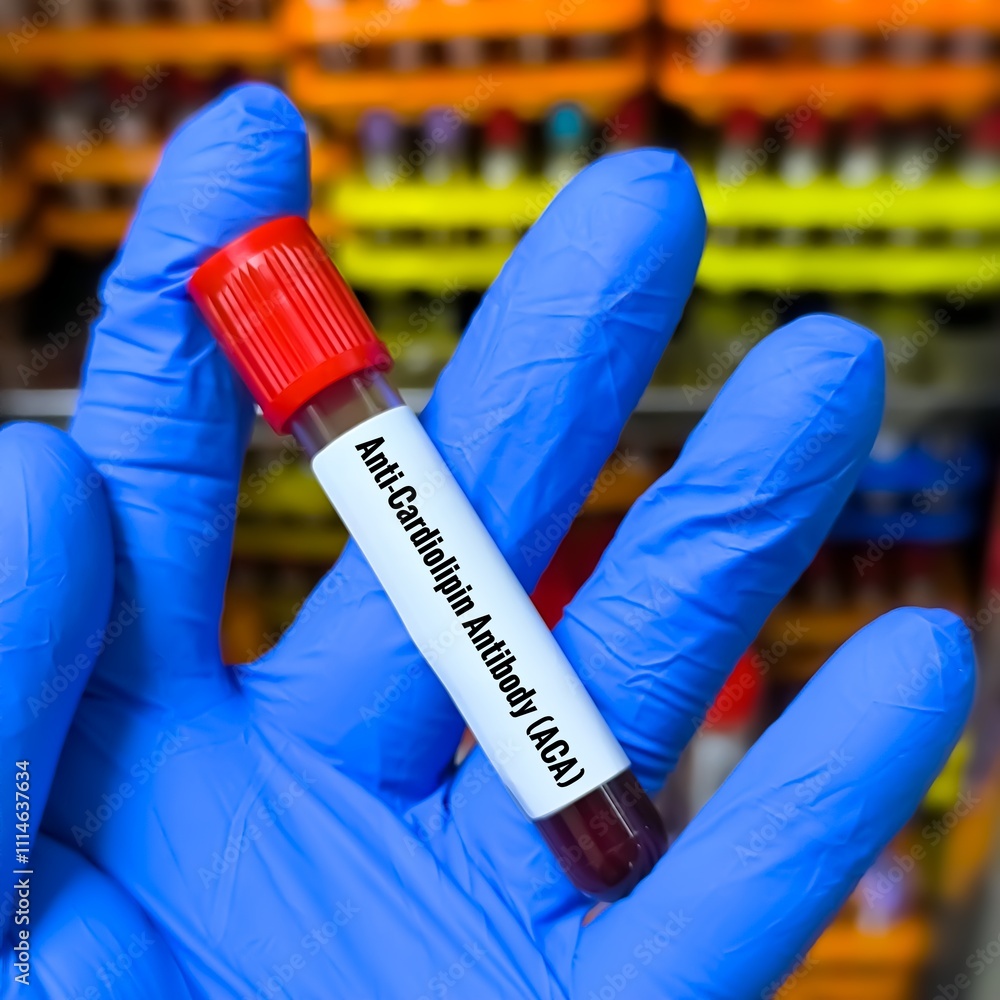 Blood sample tube for Anti Cardiolipin antibody test, antiphospholipid ...