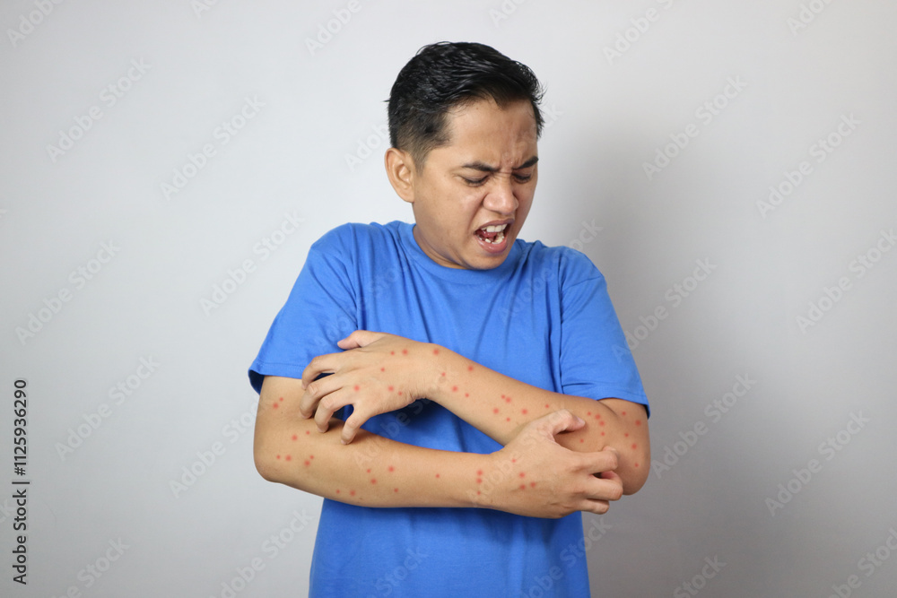 Men's hands showing rash due to Pox viral infection Painful red blistering skin Health problem ...