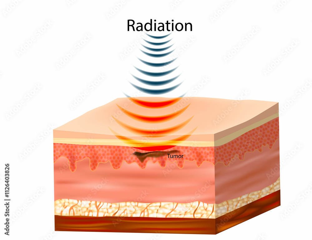 Radiation therapy or radiotherapy. Cancer treatment that uses high ...