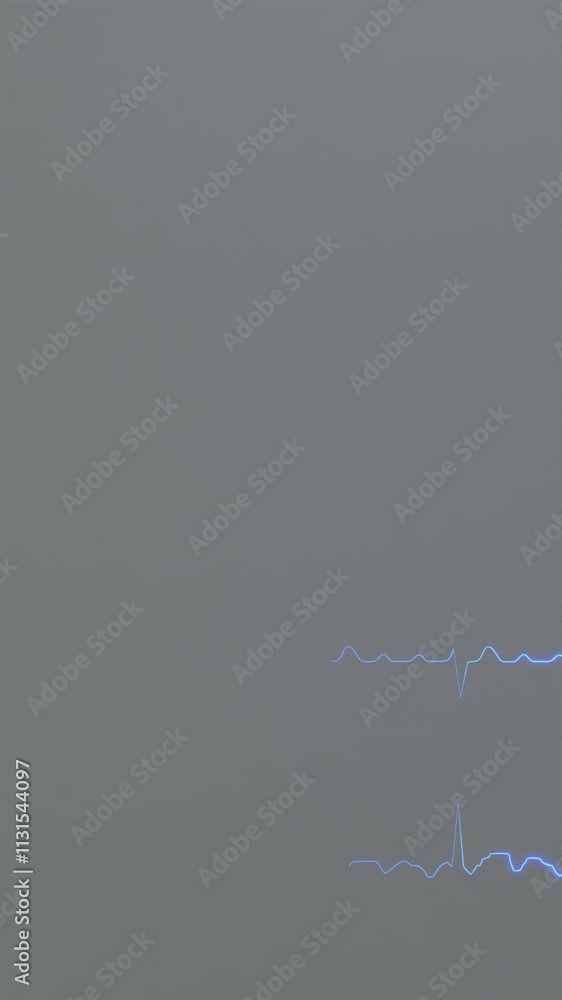 ECG graphs of regular and irregular atrial flutter Stock Video | Adobe ...