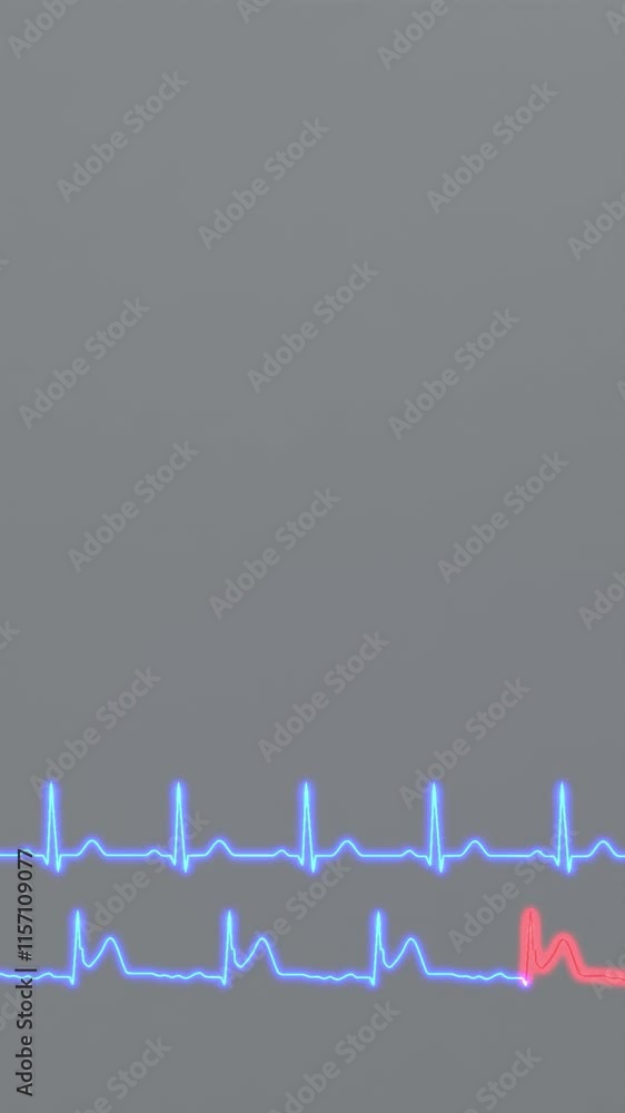 ECG comparison of the normal heart rhythm of a healthy patient and the ...