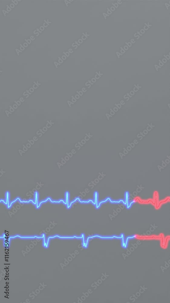 ECG of cardiac arrhythmias. Right bundle branch block and left bundle ...