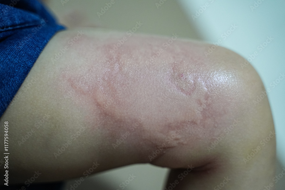 Poster Raised bumps on the child's legs, hives, itchy rash on the skin ...
