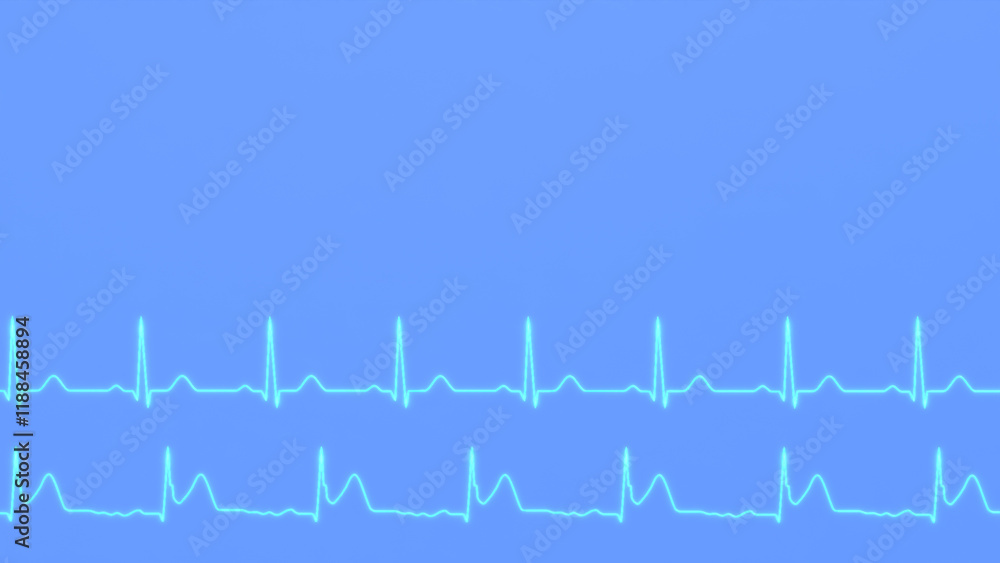 Poster ECG comparison of the normal heart rhythm of a healthy patient ...