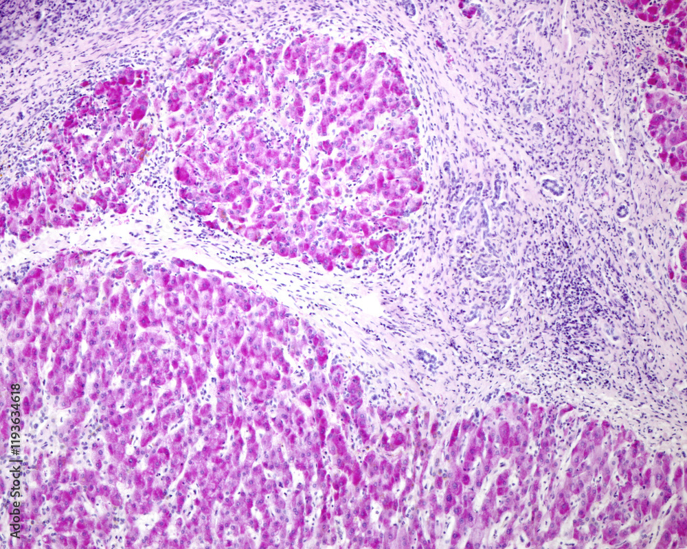 Poster Human liver. Micronodular cirrhosis. Pas method – Wall Art ...