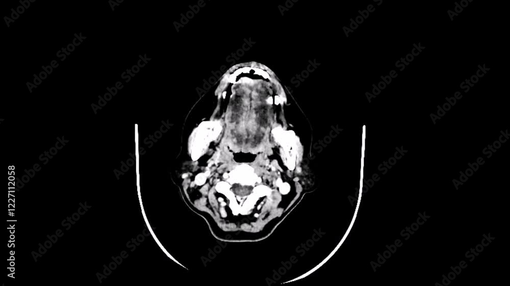 A CT scan of the brain , show large brain infarctions caused by embolic ...