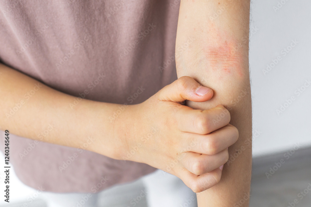 Plakát A child scratching an irritated red rash on their arm, showing ...