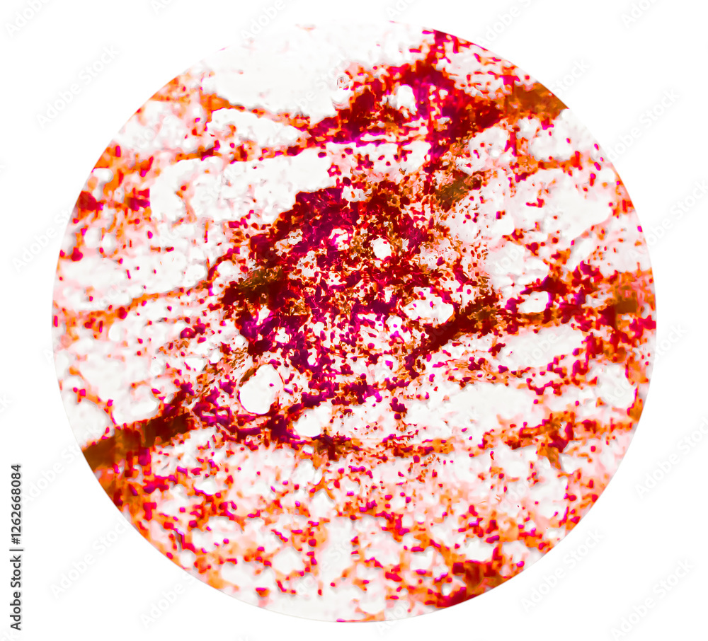 Poster Malignant cells, bronchoalveolar lavage (BAL) adenocarcinoma ...