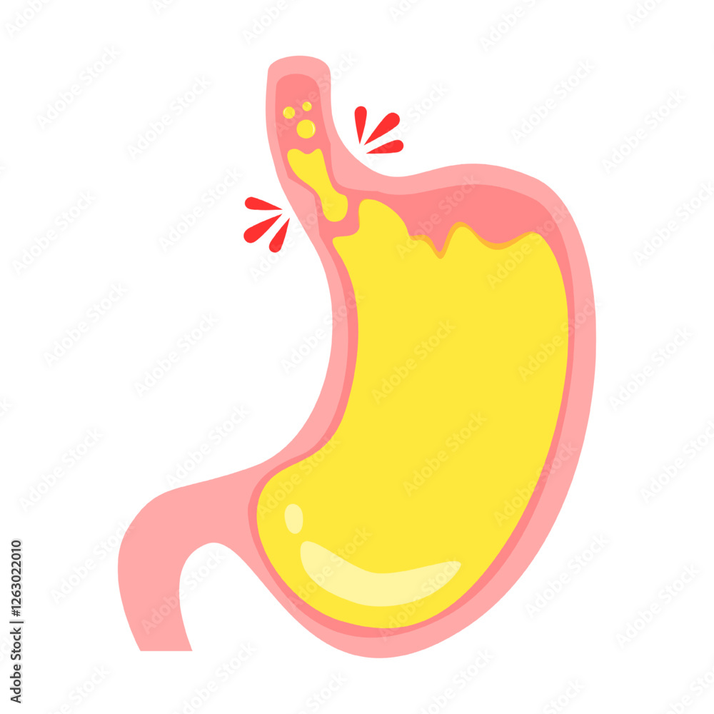 Poster Gastroesophageal Reflux Disease (GERD) with the esophageal ...