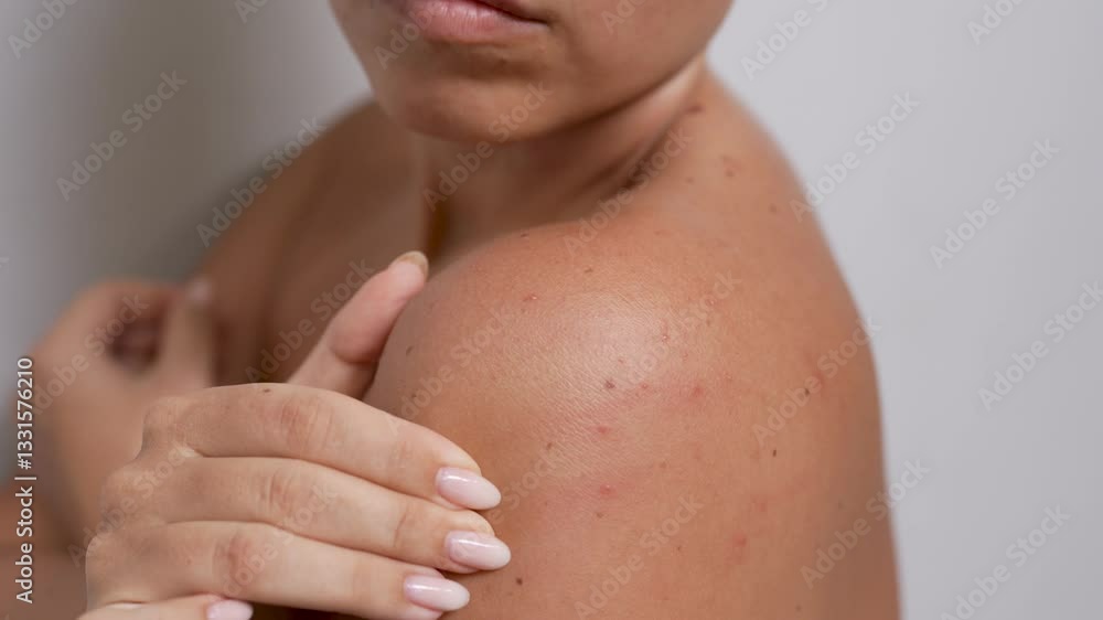 Close-up of a young woman touching pimples on her shoulder with her ...