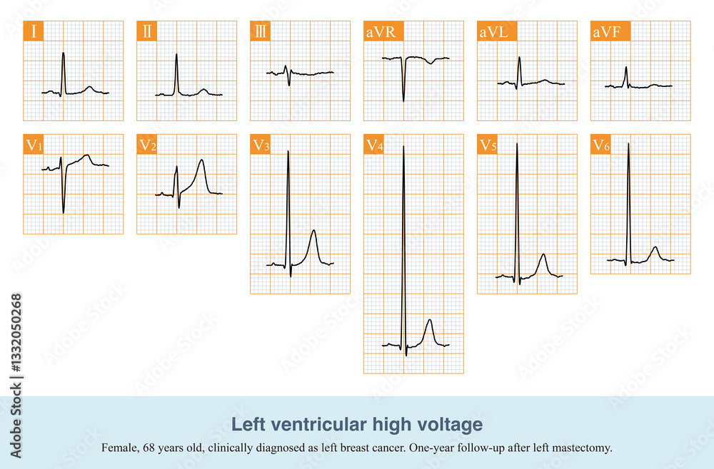 Plakát Simple left ventricular high voltage has no abnormalities such ...