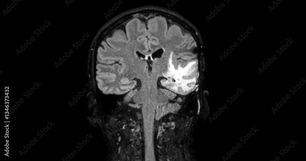 MRI scan reveals a lesion in the left hemisphere of the brain ...