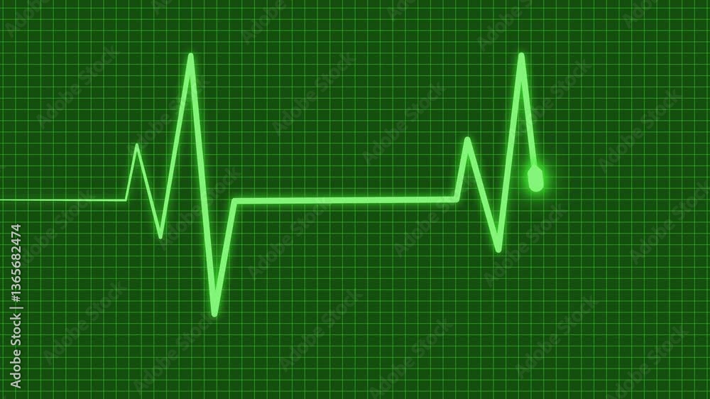 ECG Heartbeat with Flatline and Spike Animation, A electrocardiogram ...