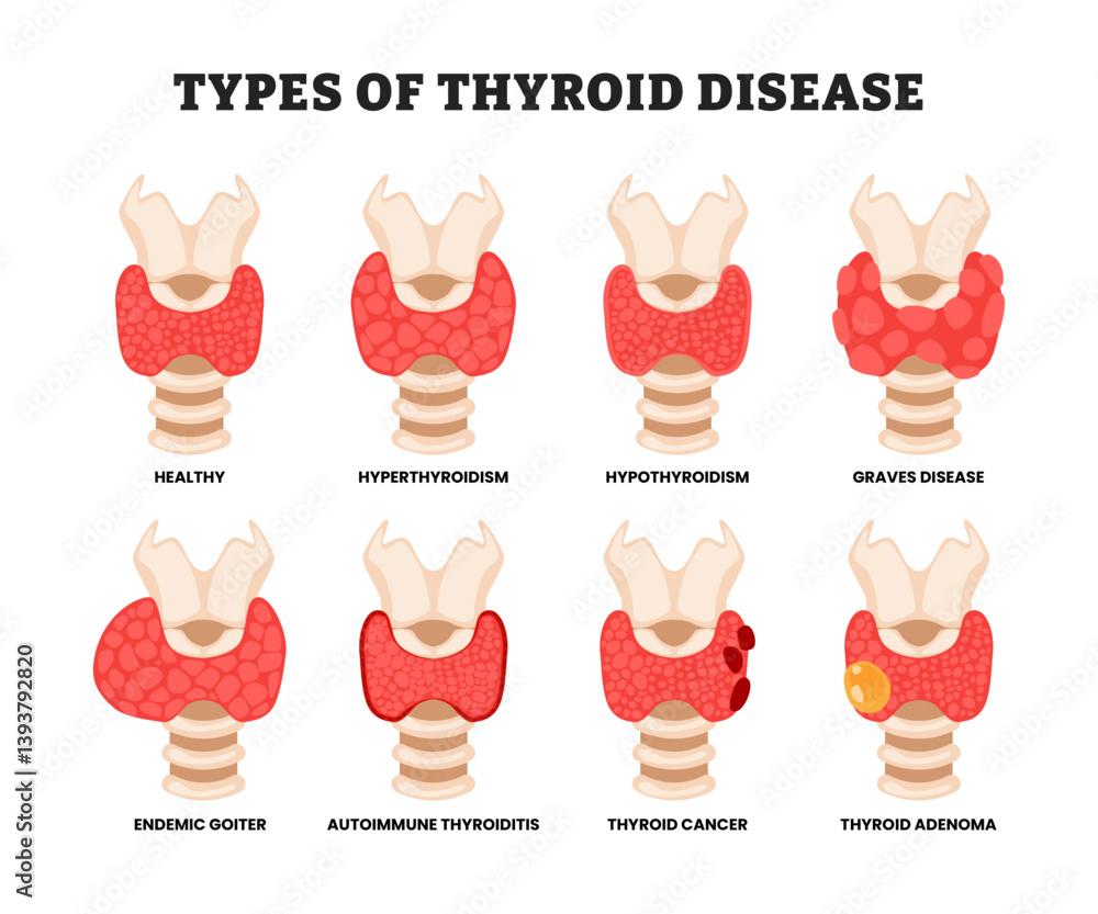 Poster Different types of thyroid disease types, educational medical ...