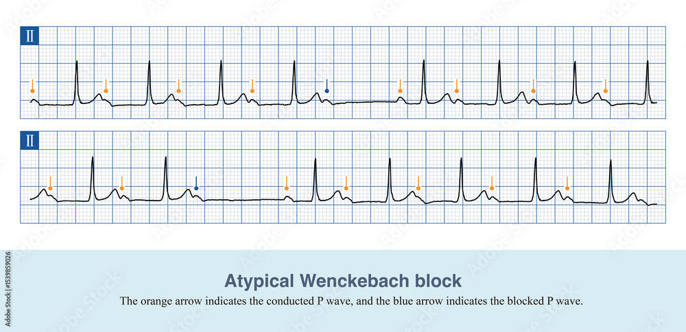 Poster In clinical practice, the most common type of second degree type ...