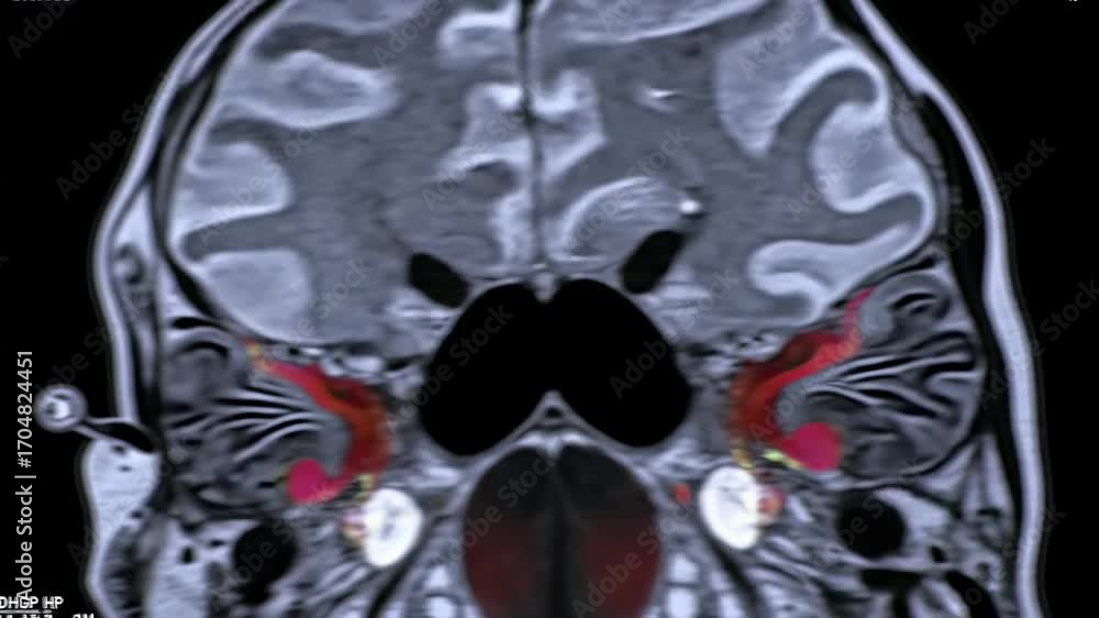 High-resolution coronal MRI of the human head displaying brain anatomy ...