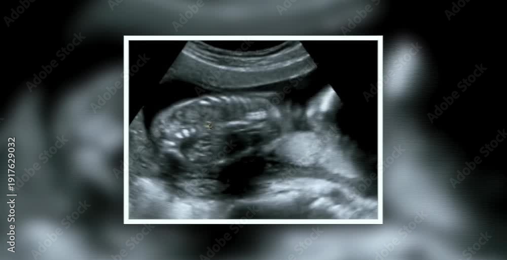 Prenatal ultrasound monitor displaying fetus during routine pregnancy ...