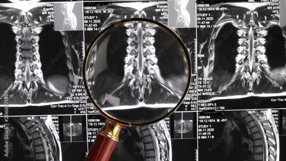 Magnifying glass examines detailed MRI scans of spine showing vertebrae ...